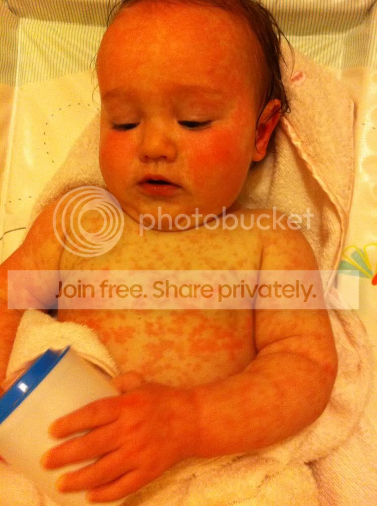 Roseola Virus | BabyCentre